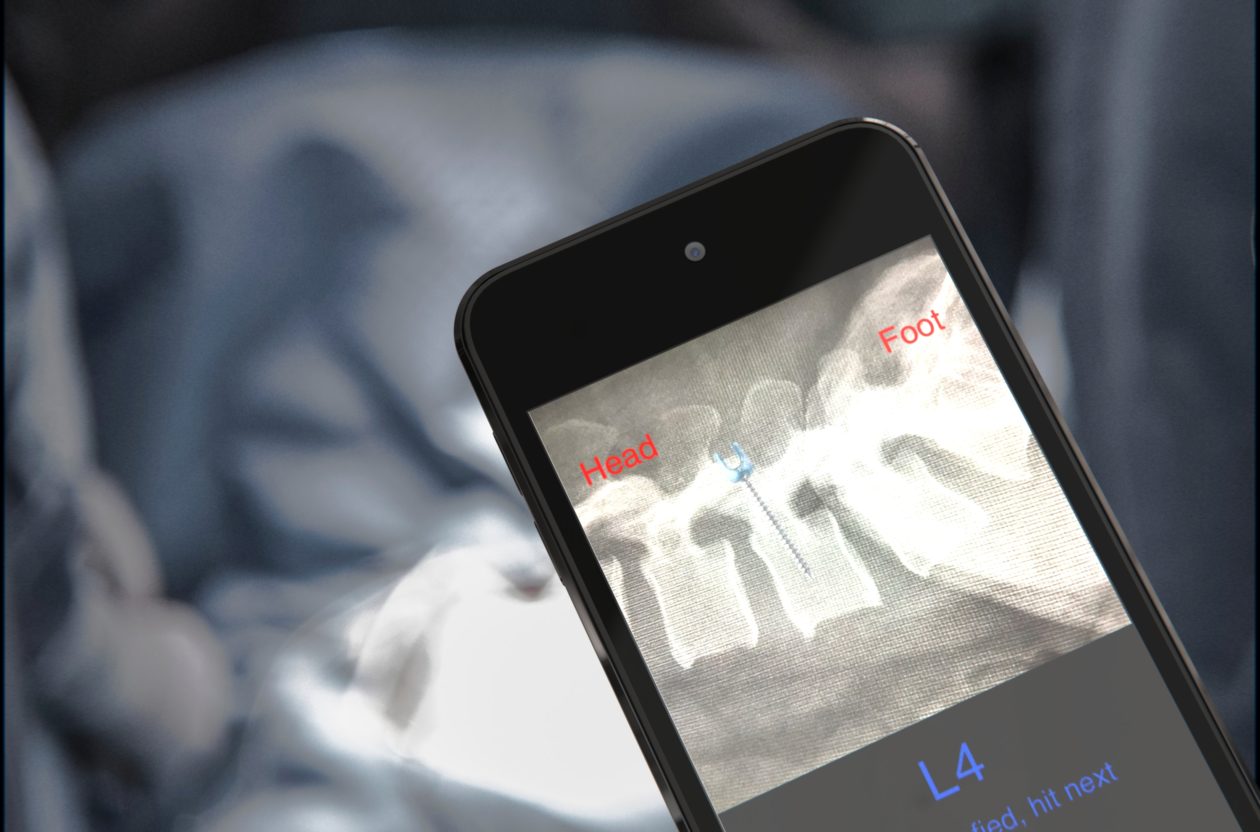 Bolt Nav - Spinal Surgery, Simplified