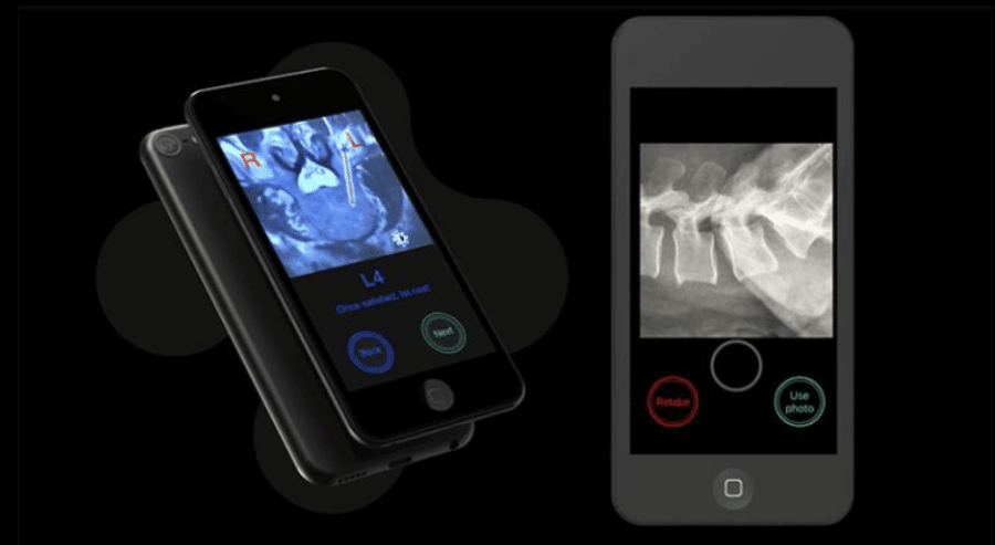 First Bolt Procedure Performed in the US - Bolt Nav